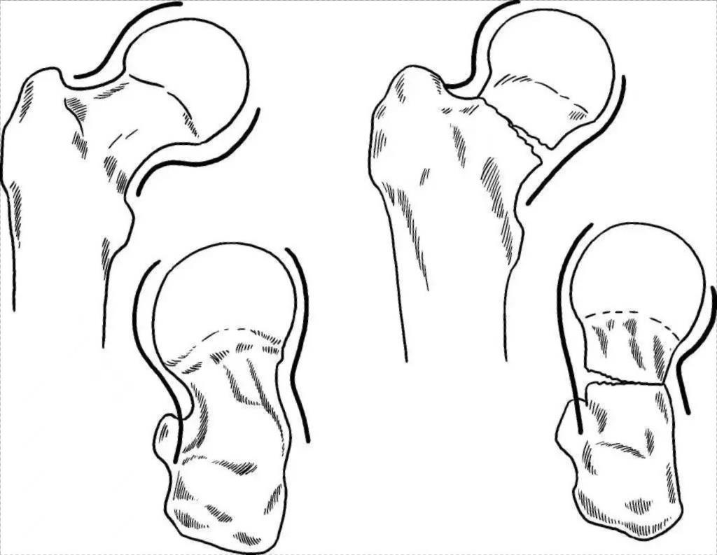 Closed reduction surgery for lower extremity fractures - CZMEDITECH