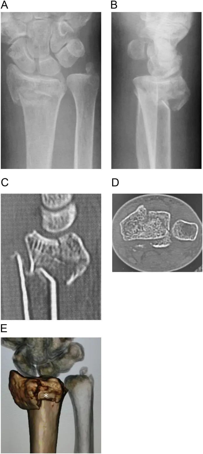 New techniques for volar plate fixation of distal radius fractures ...