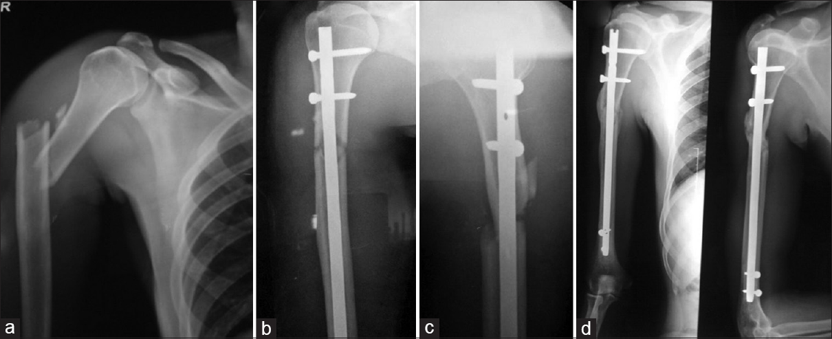 Humerus Intramedullary Nail: An Effective Solution for Treating Humeral ...