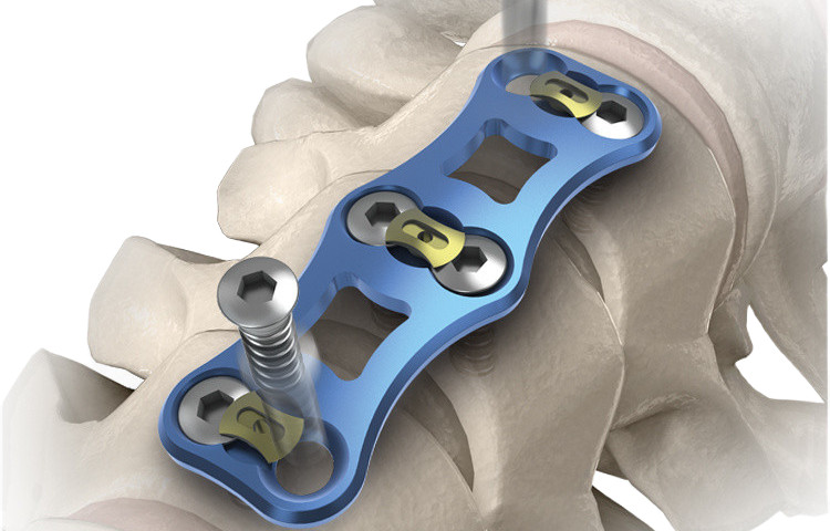 What are cervical implants? - CZMEDITECH